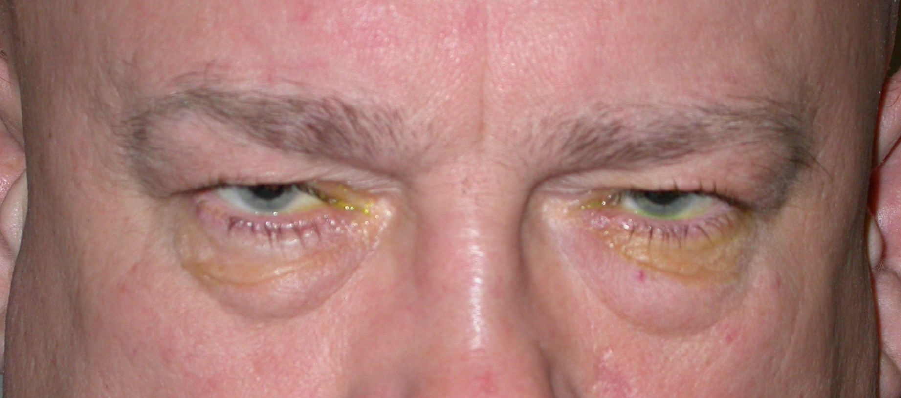 Droopy Eyelid Surgery in NYC | Manhattan Surgical Care